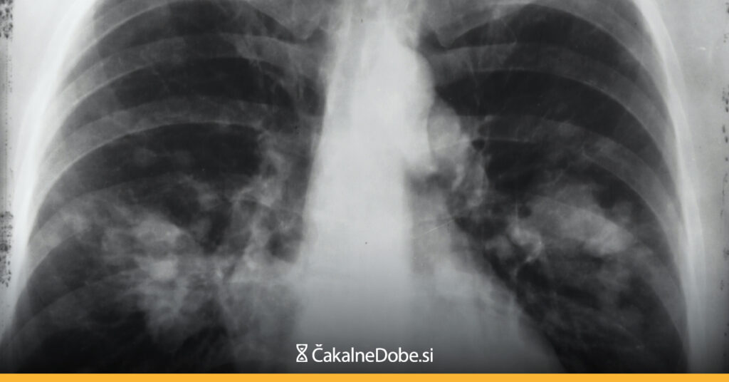 Rak na pljučih ni le bolezen kadilcev! - Čakalne dobe